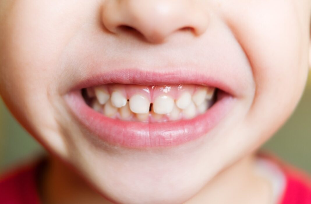 The Role of Baby Teeth in Speech Development - Your Dental Health Resource